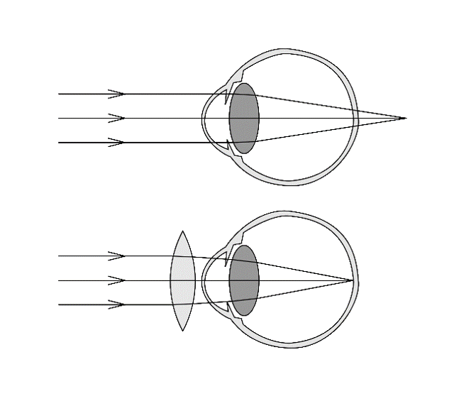 L’HYPERMÉTROPIE - Cabinet d’ophtalmologie thiers bordeaux